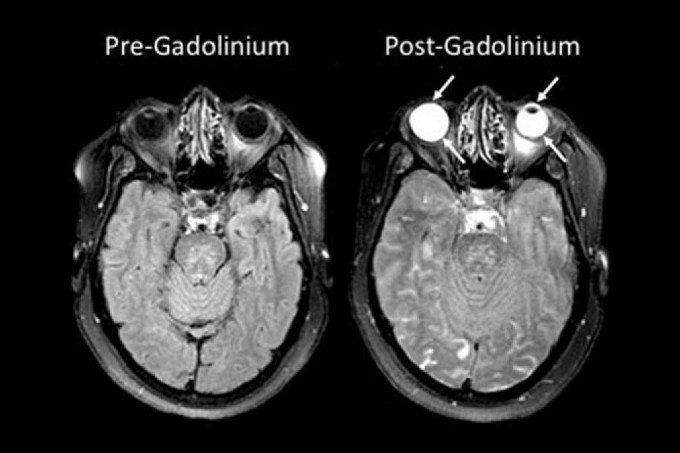 Gadolinium Based Contrast Media – Serena's Blog